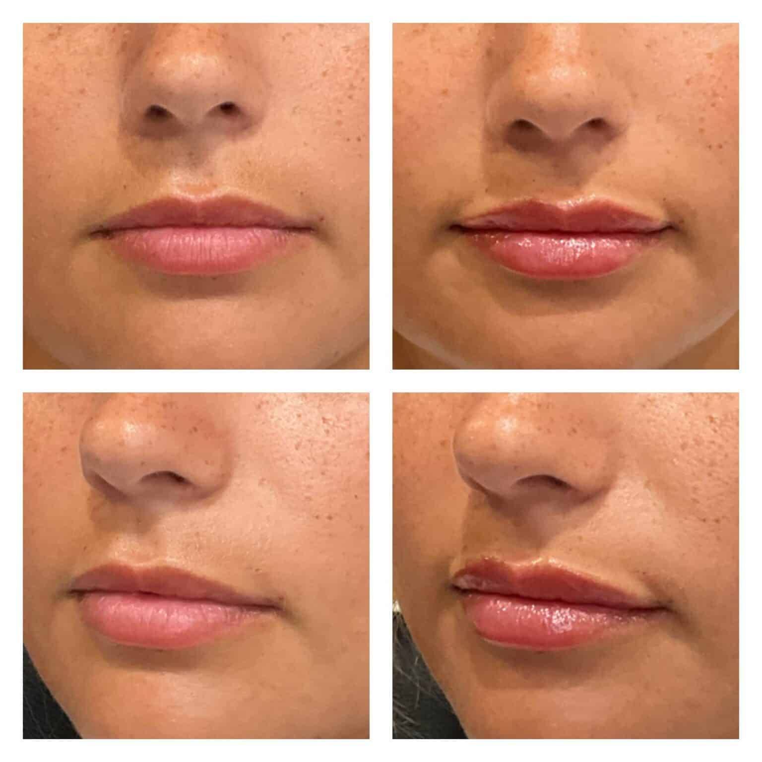 Botox & Filler Before and After - Esthetic Finesse
