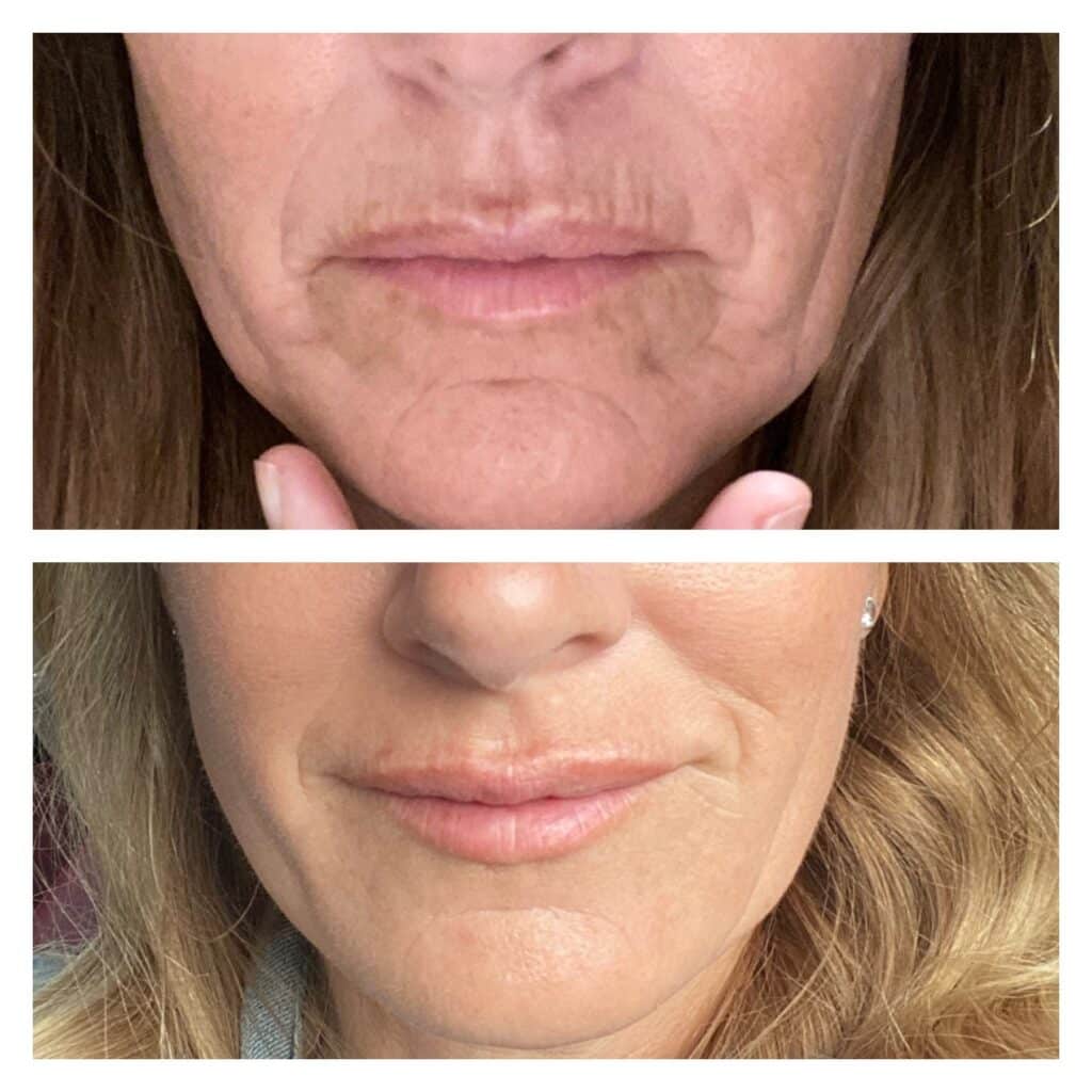 Botox & Filler Before and After - Esthetic Finesse