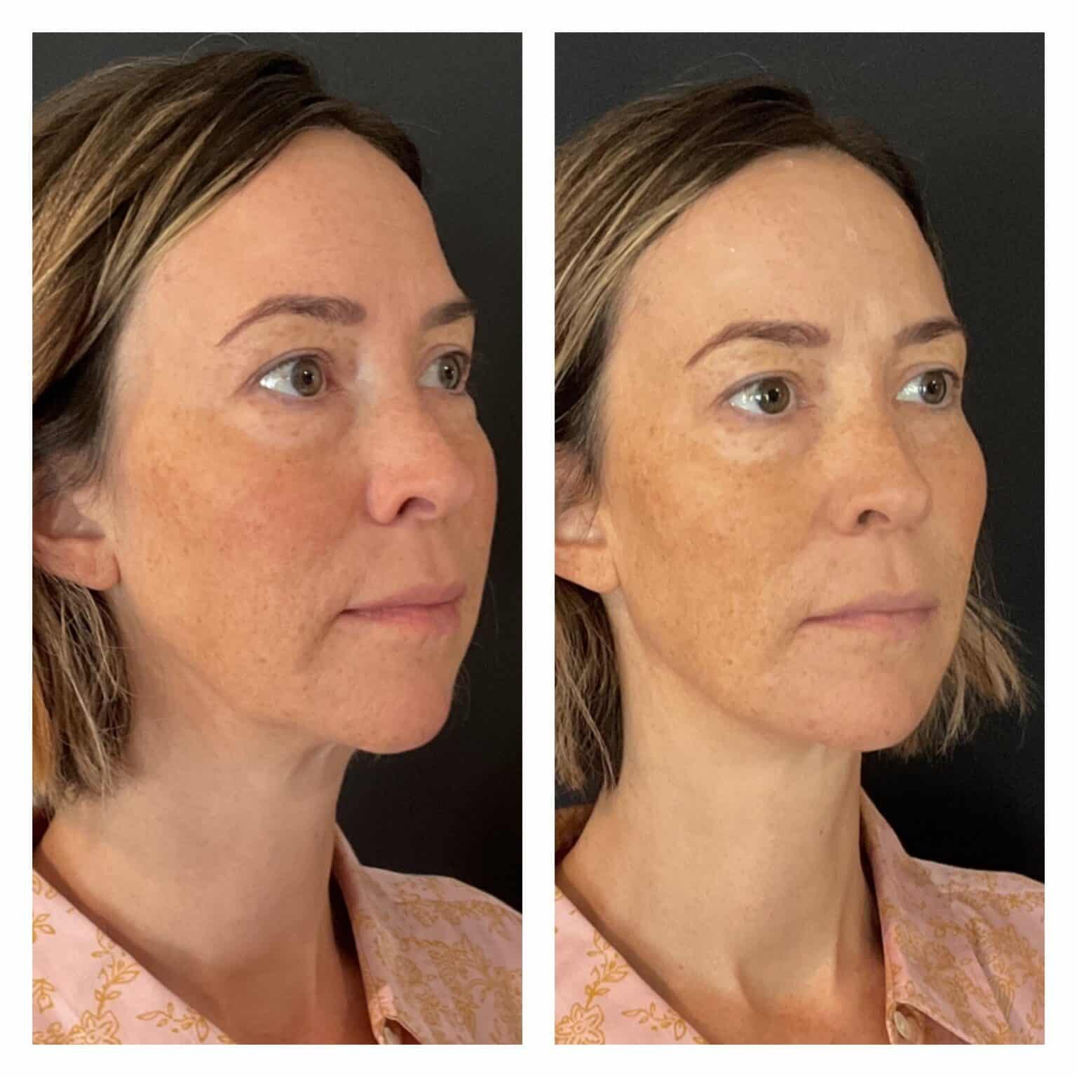 Botox & Filler Before and After - Esthetic Finesse