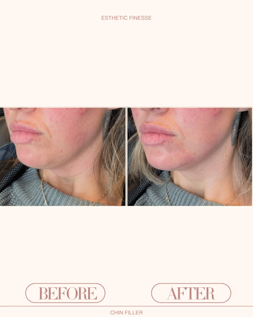 Chin Filler Scottsdale - Profile Balancing by Nurse Diane