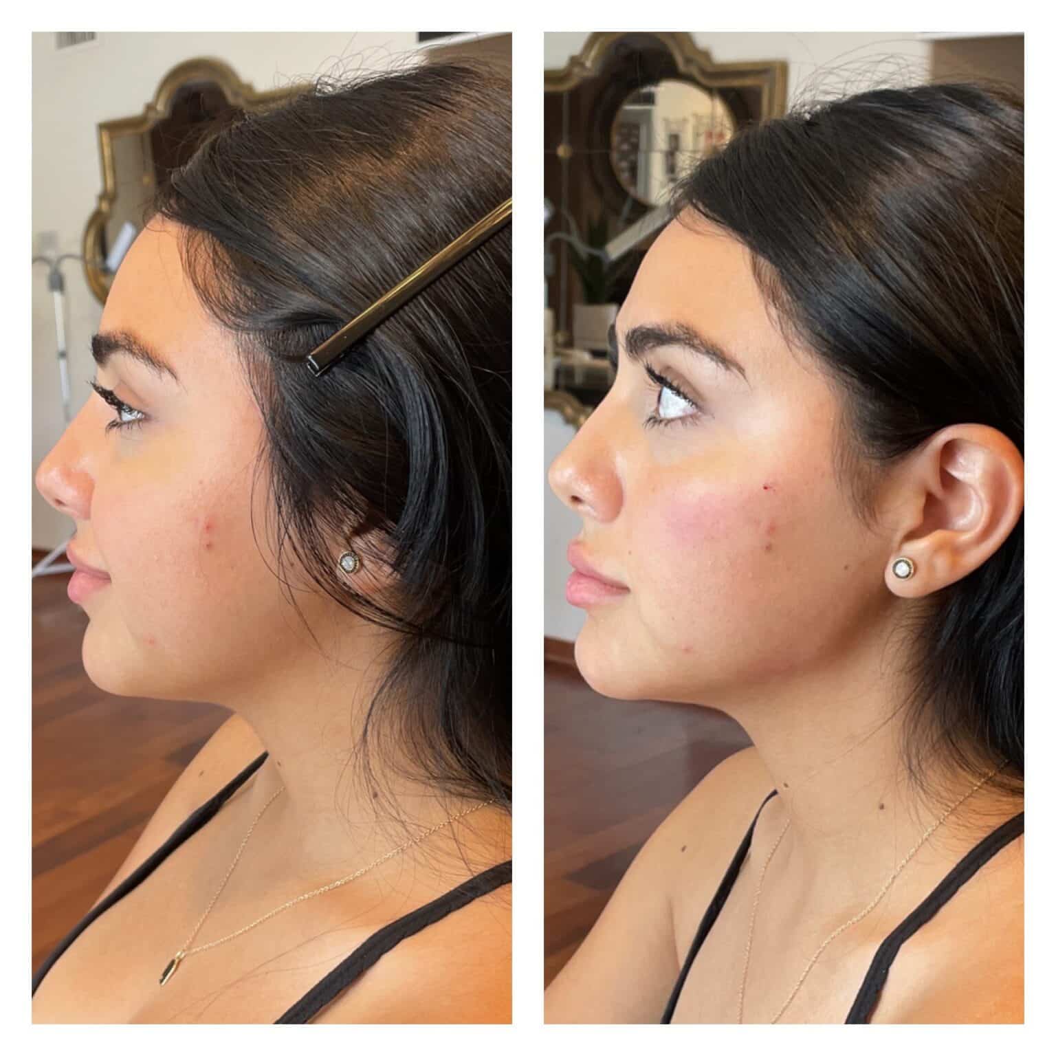 Botox & Filler Before and After - Esthetic Finesse