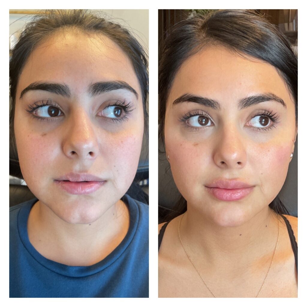 Before & After - Esthetic Finesse